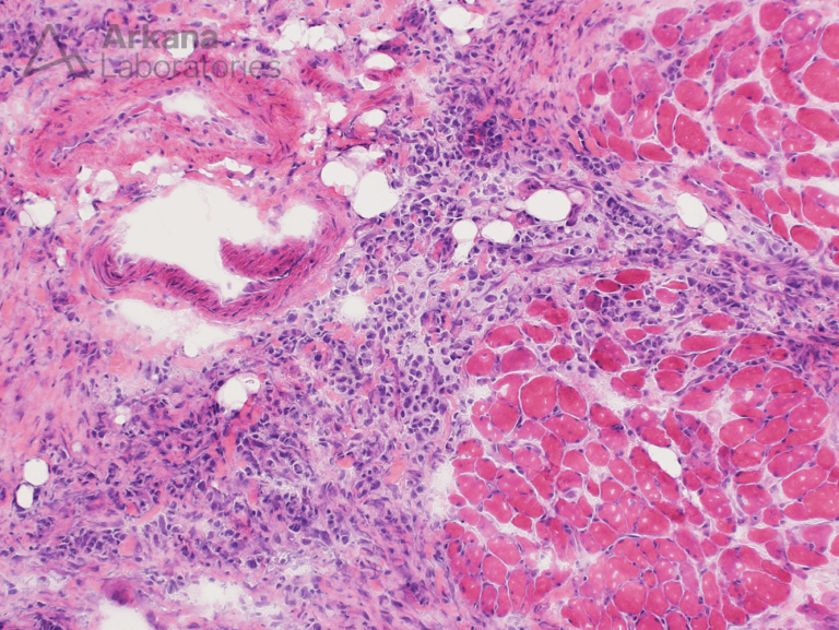 Signet Ring Carcinoma - Arkana Laboratories