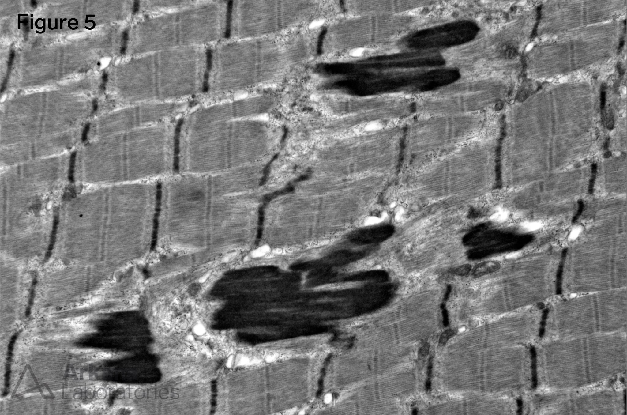 Nemaline Myopathy - Arkana Laboratories