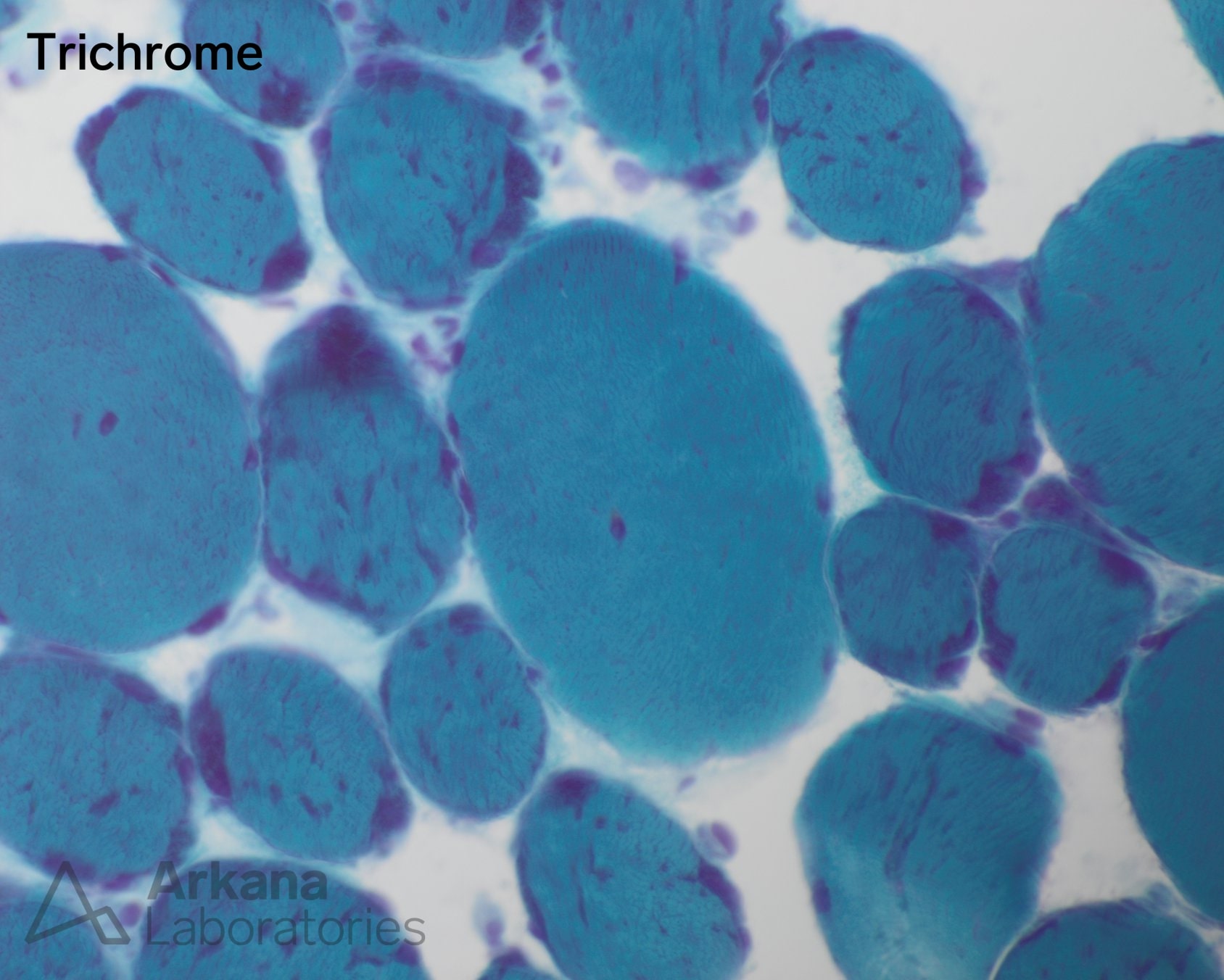 Nemaline Myopathy - Arkana Laboratories