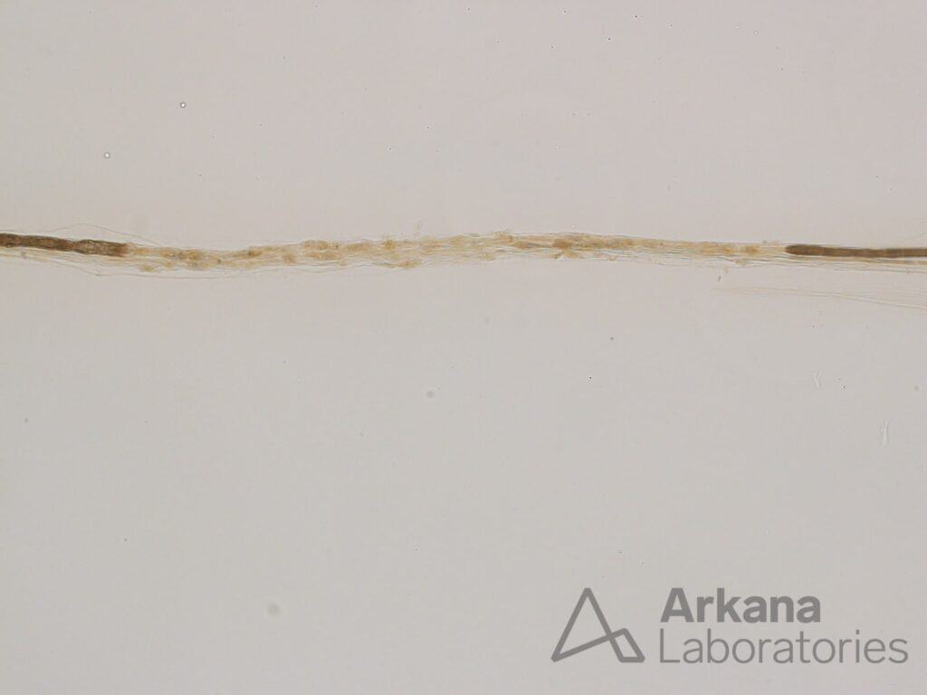 AIDP / Guillain-Barré syndrome - Arkana Laboratories