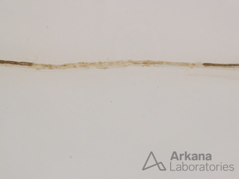 AIDP / Guillain-Barré syndrome - Arkana Laboratories