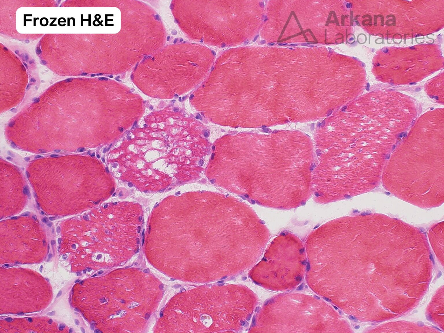 Adult Onset Pompe Disease/Acid Maltase Deficiency - Arkana Laboratories