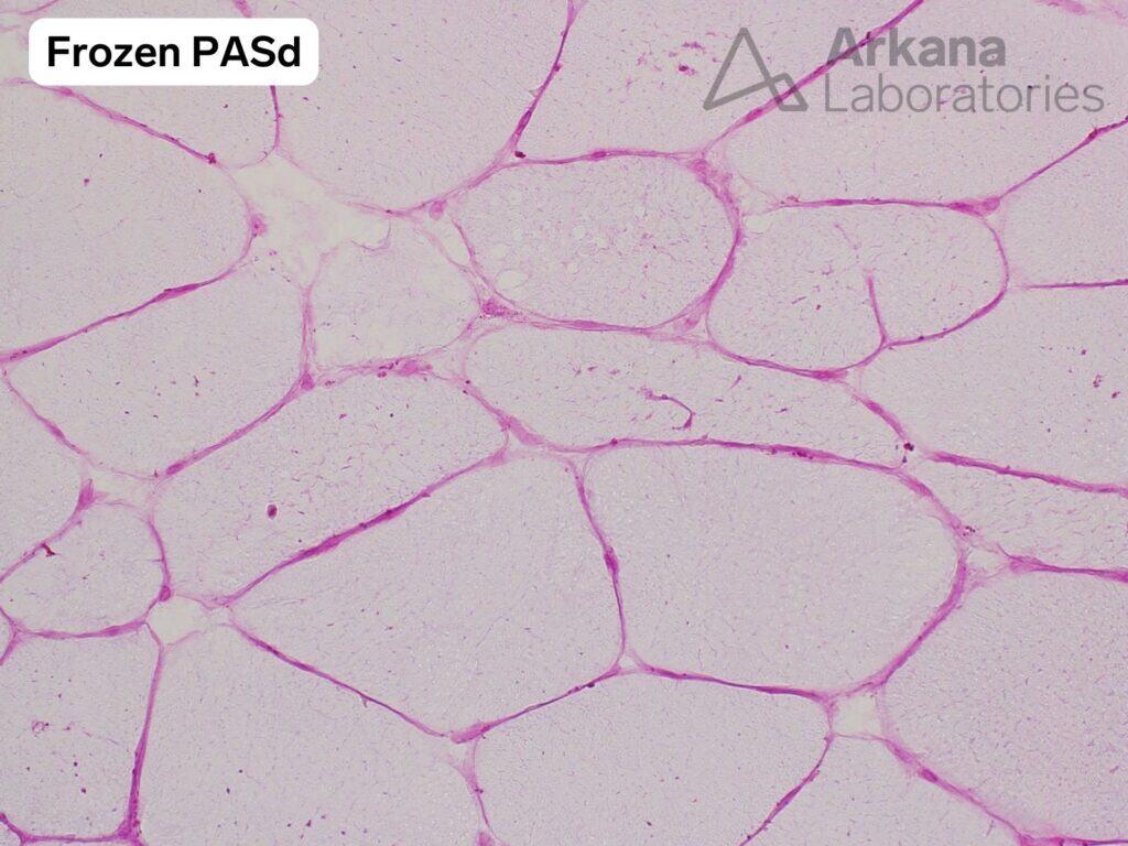 Adult Onset Pompe Disease/Acid Maltase Deficiency - Arkana Laboratories