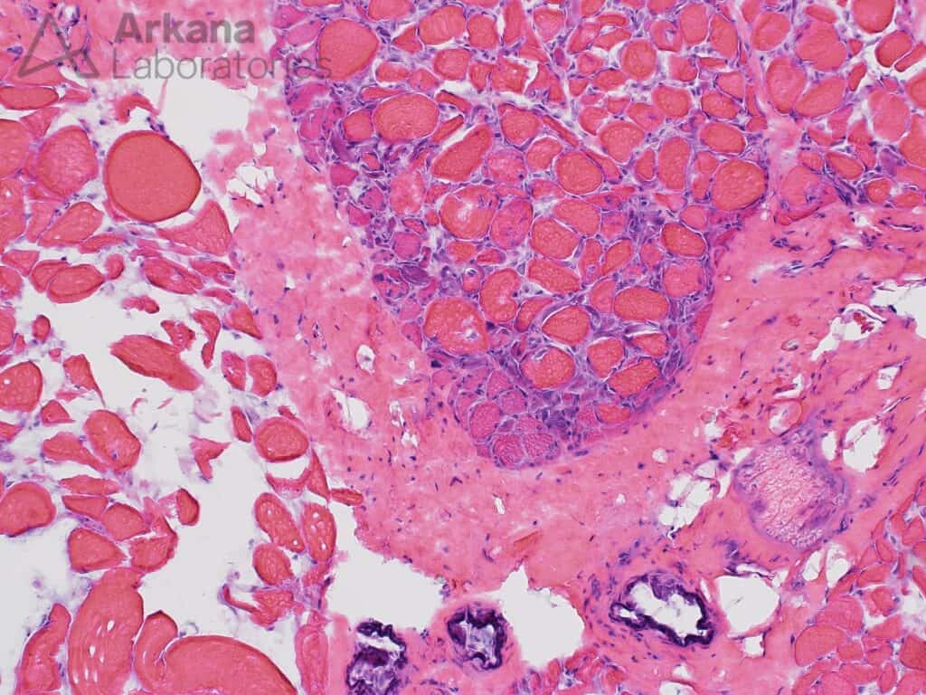 Calciphylaxis | Neuro Notes | Arkana Laboratories