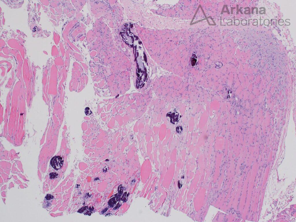 Calciphylaxis | Neuro Notes | Arkana Laboratories