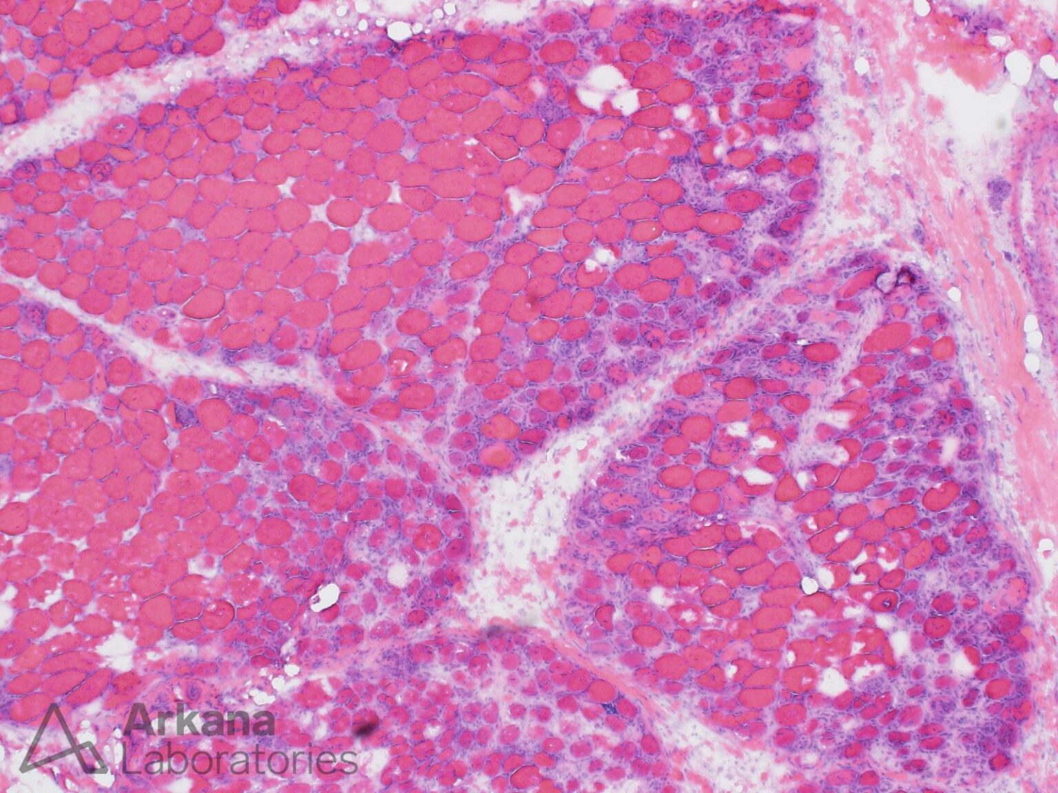 Partially necrotic and regenerating myofibers | Neuro Notes | Arkana ...