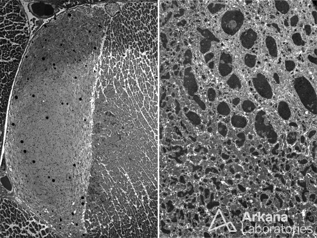 Cap myopathy | Neuro Notes | Arkana Laboratories