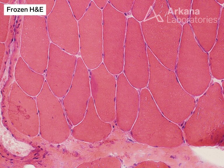 Cap myopathy | Neuro Notes | Arkana Laboratories