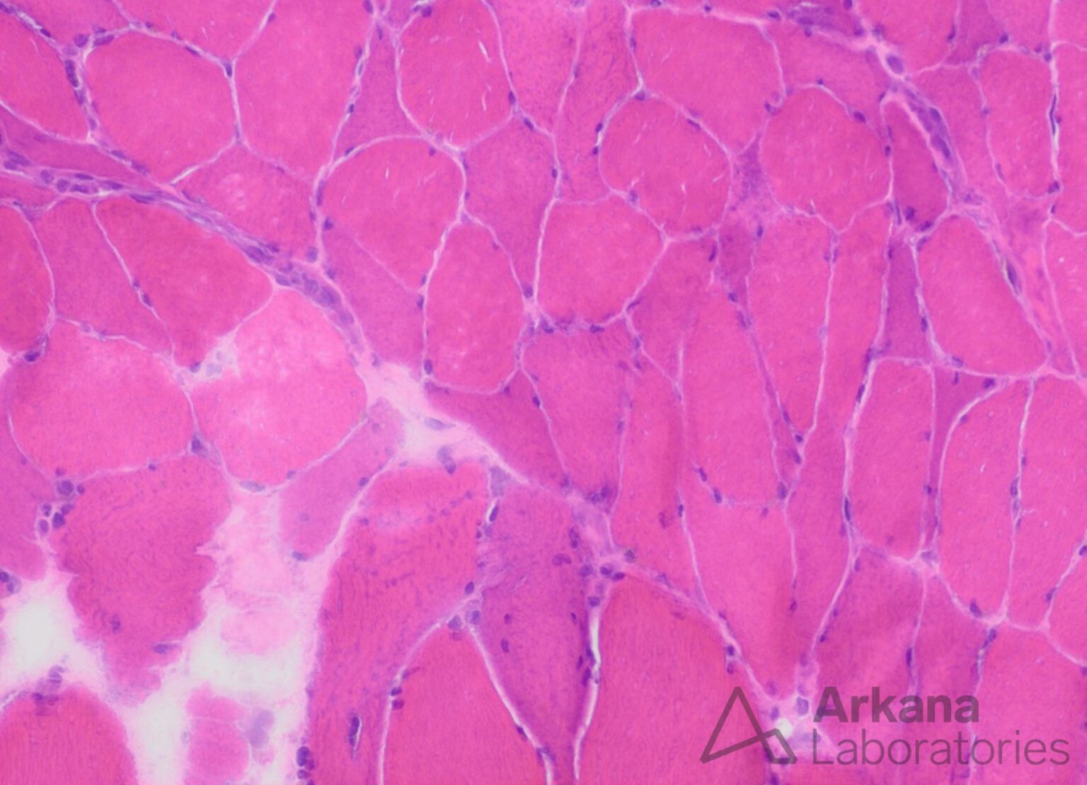 71-year-old man with proximal weakness - Arkana Laboratories