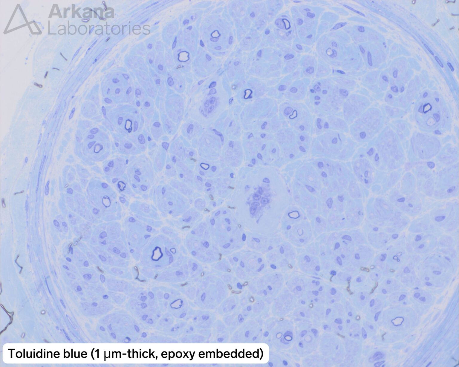 Chronic Inflammatory Demyelinating Polyneuropathy (CIDP) | Neuro Notes