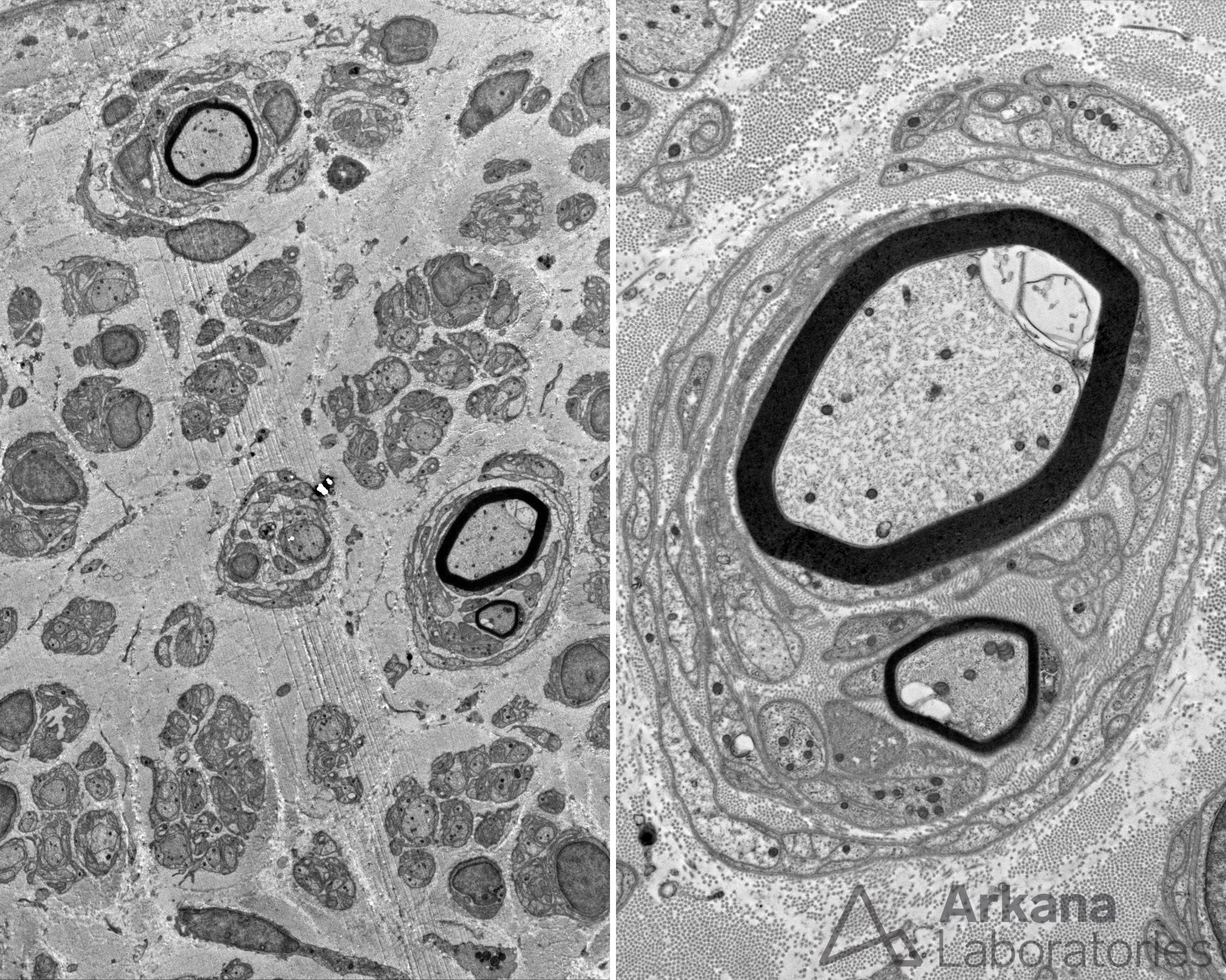 Chronic Inflammatory Demyelinating Polyneuropathy (CIDP) | Neuro Notes