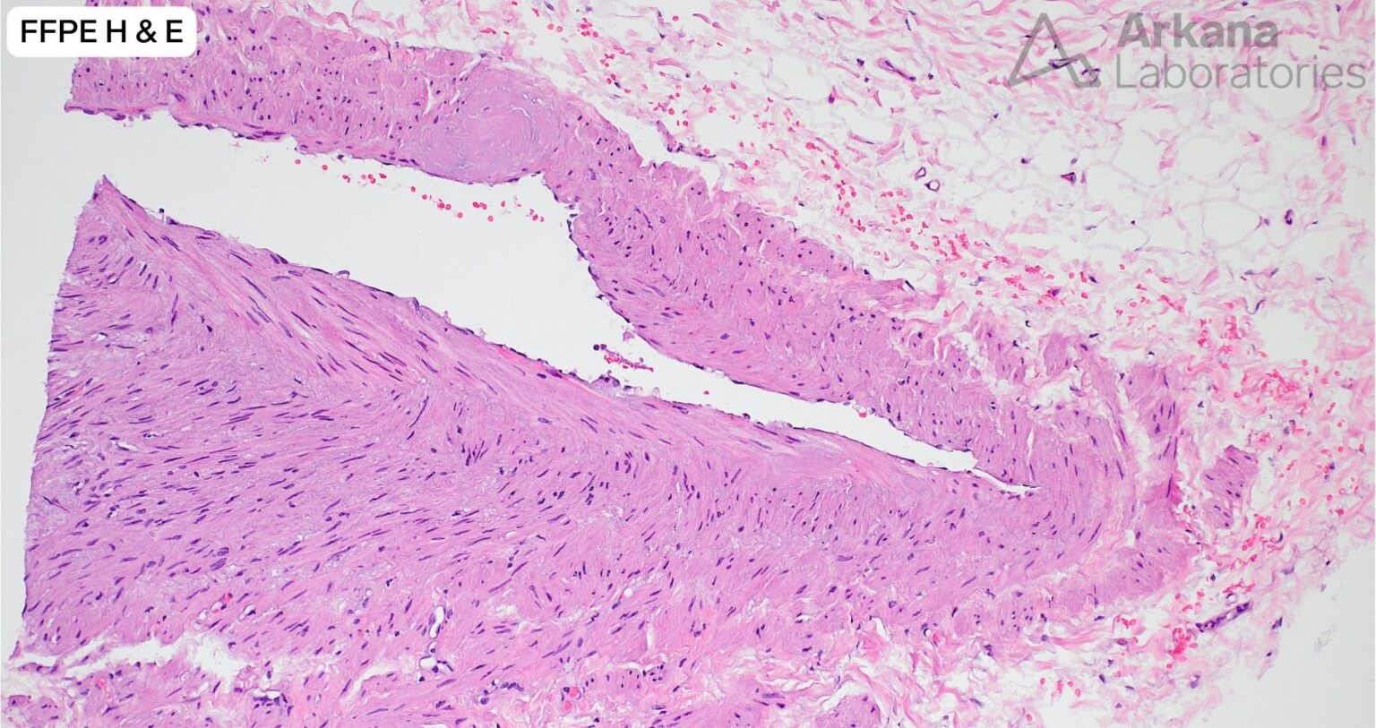 Denervation with Incidental Vascular Amyloid | Neuro Notes | Arkana Labs