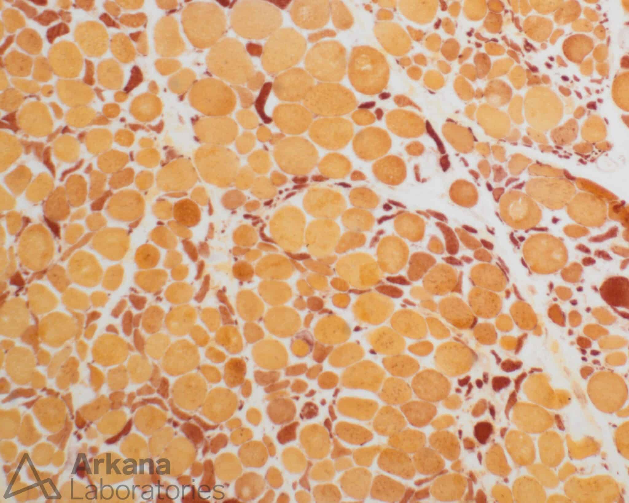 68-Year-Old Man With Weakness | Neuro Notes | Arkana Laboratories