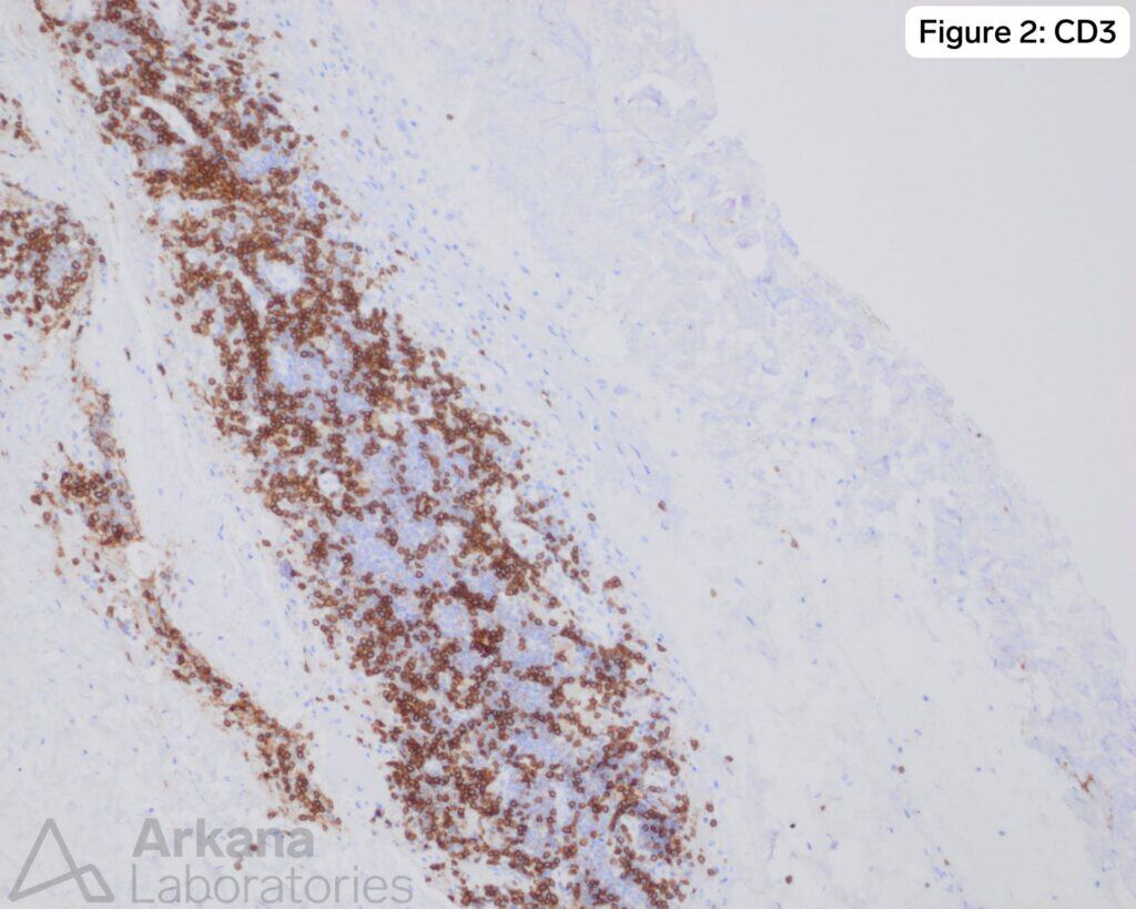Vasculitis with Fibrinoid Necrosis | Neuro Notes | Arkana Labs