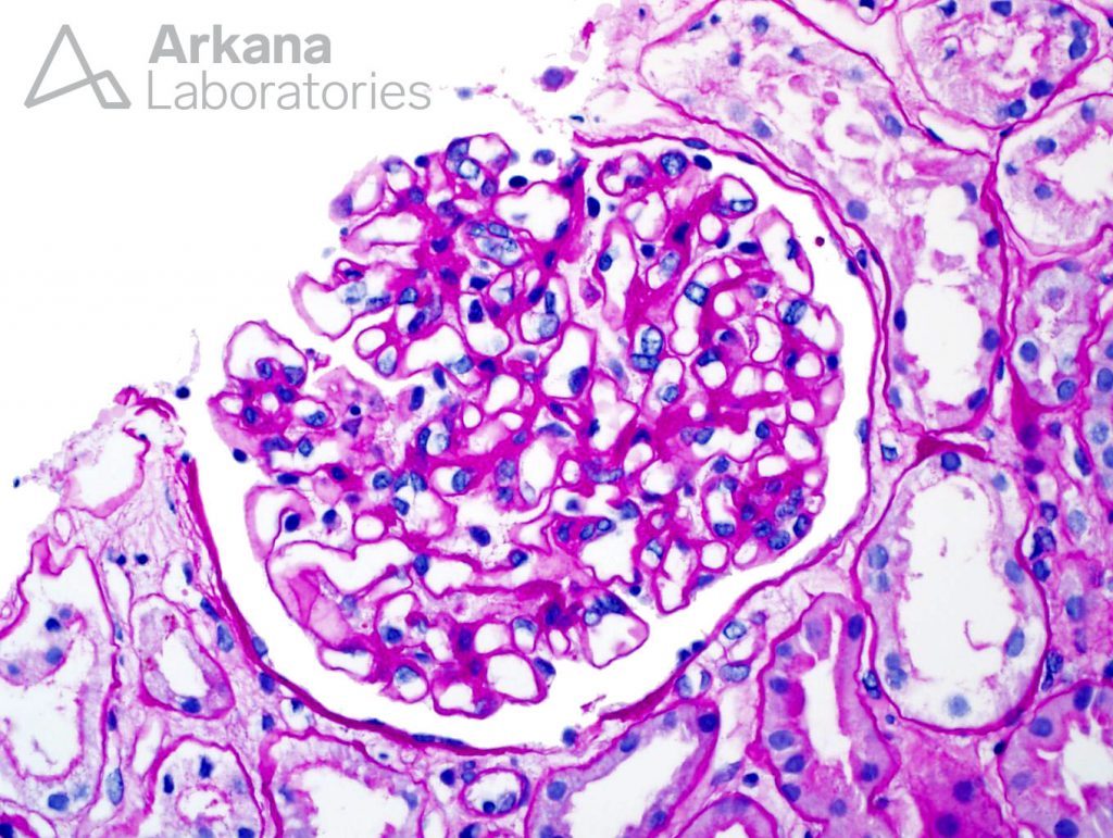 Thrombotic Microangiopathy | Teaching Points | Arkana Laboratories