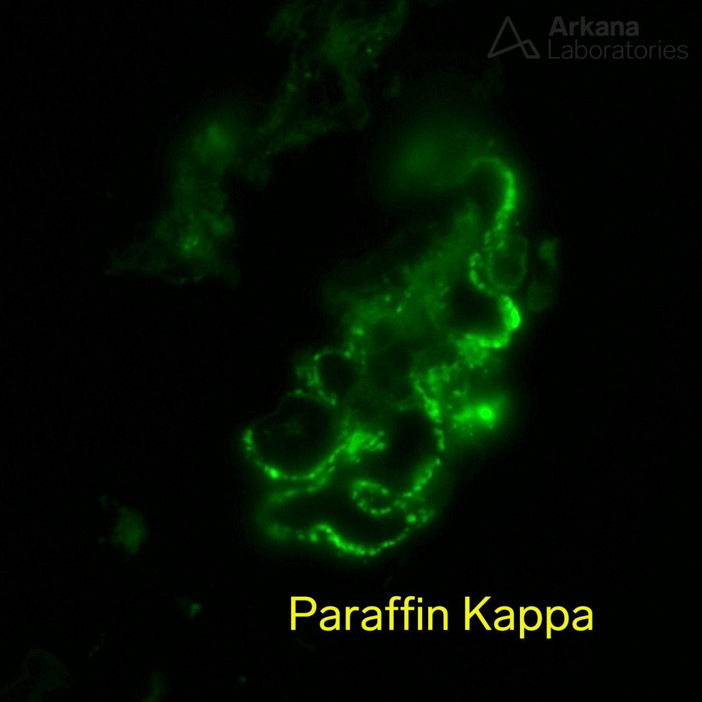 Masked IgG-Kappa Deposits | Teaching Points | Arkana Laboratories