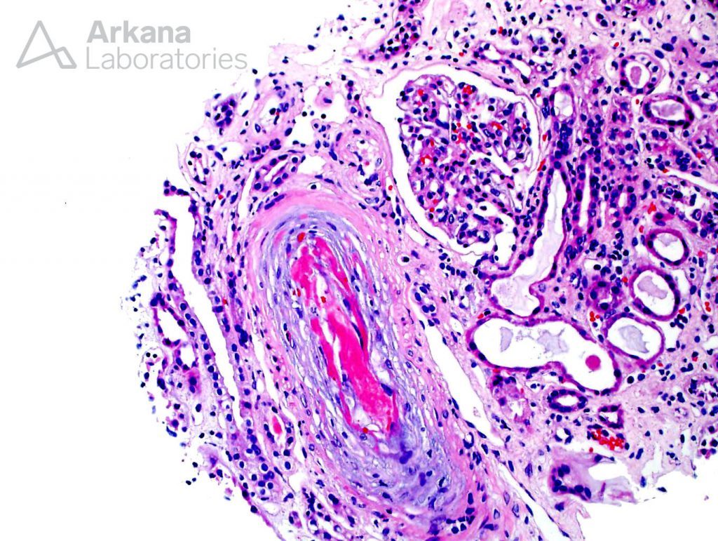 Thrombotic Microangiopathy | Teaching Points | Arkana Laboratories