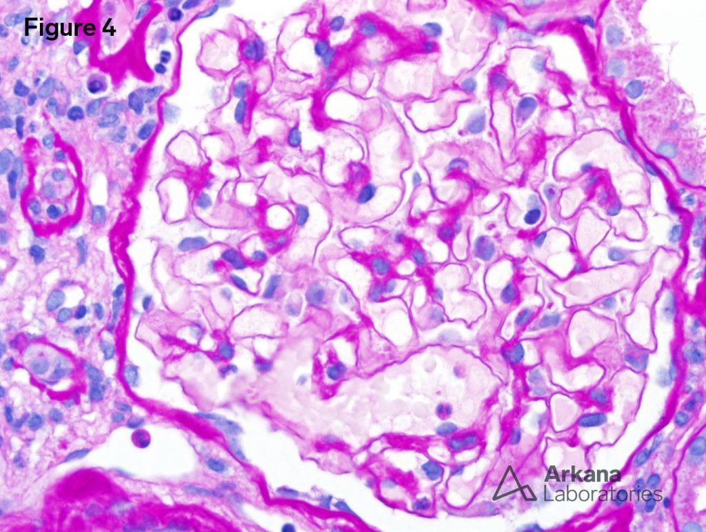 Chronic Active Tubulointerstitial Nephritis | Teaching Points