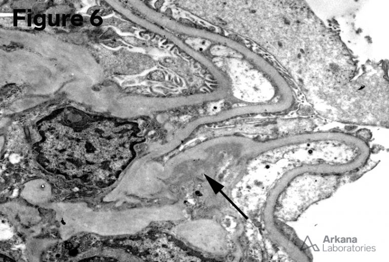 Proliferative Glomerulonephritis with Monoclonal IgG Deposits (PGMID)