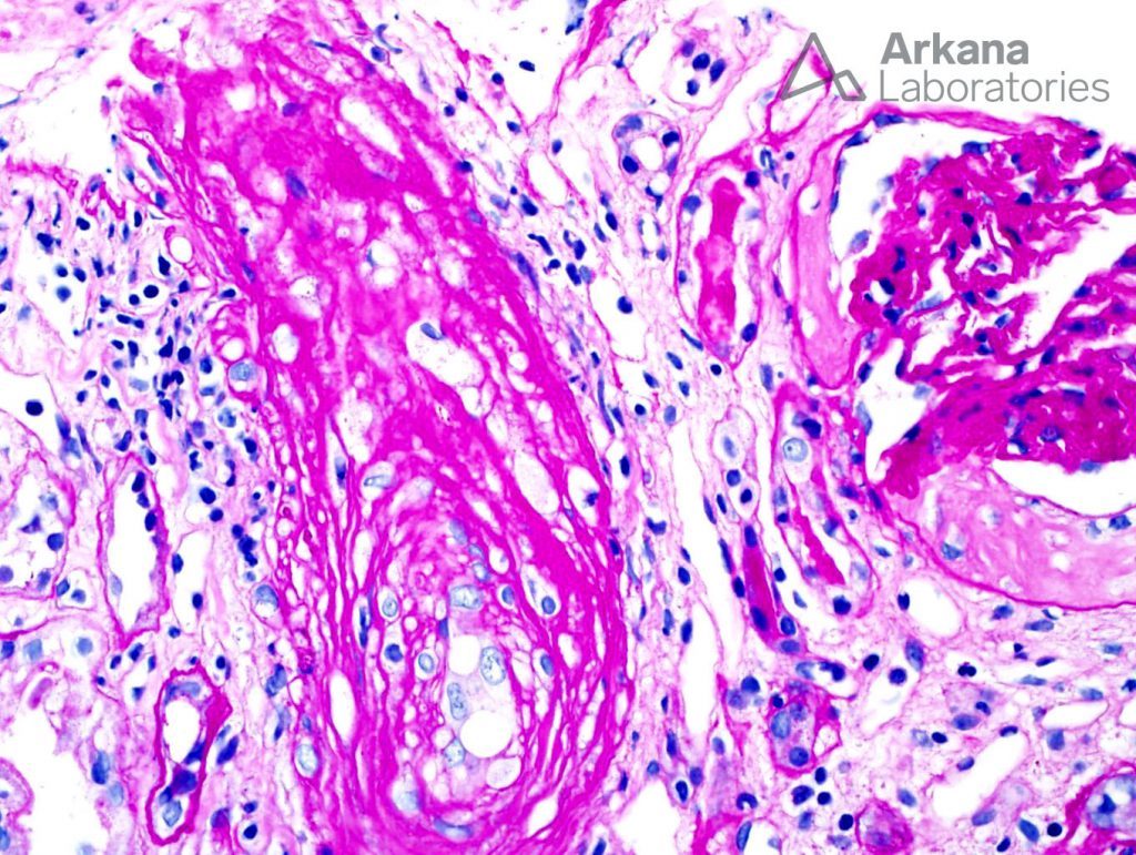 Thrombotic Microangiopathy | Teaching Points | Arkana Laboratories