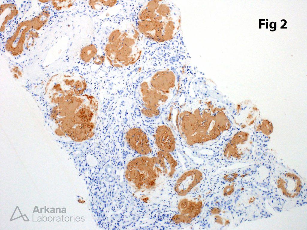 AA Amyloid | Teaching Points | Arkana Laboratories