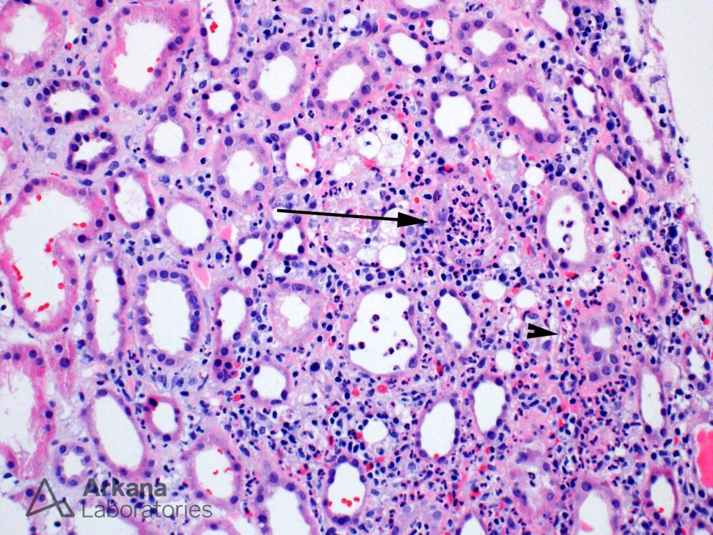 Acute Pyelonephritis | Teaching Points | Arkana Laboratories