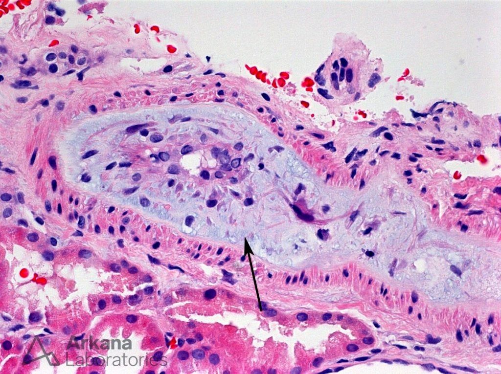 Opana Associated TTP-Like Illness | Teaching Points | Arkana Laboratories