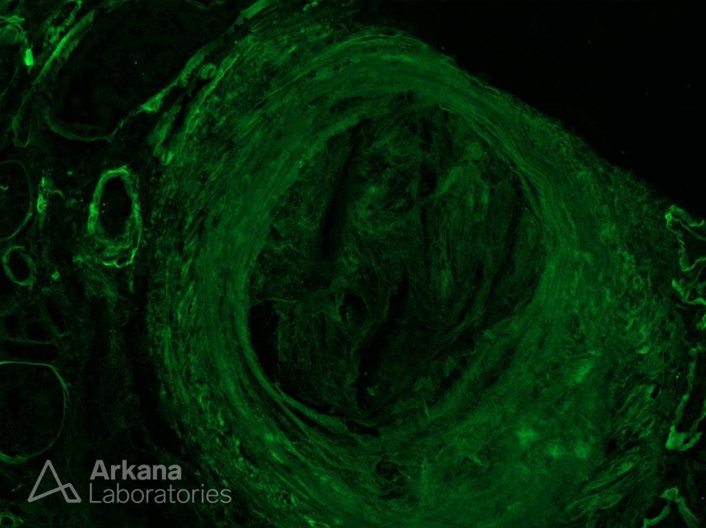 Atheroemboli | Teaching Points | Arkana Laboratories