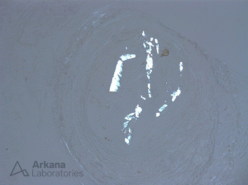 Atheroemboli | Teaching Points | Arkana Laboratories