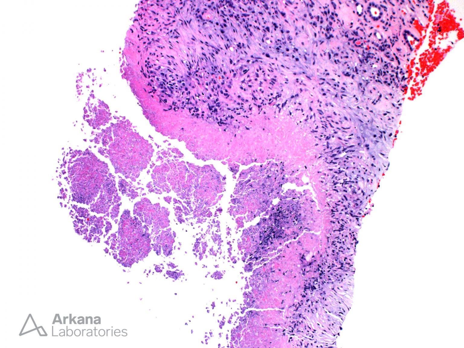 Caseating Granuloma | Teaching Points | Arkana Laboratories
