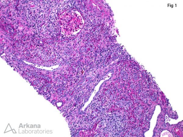 Chronic Active Tubulointerstitial Nephritis | Teaching Points | Arkana Labs