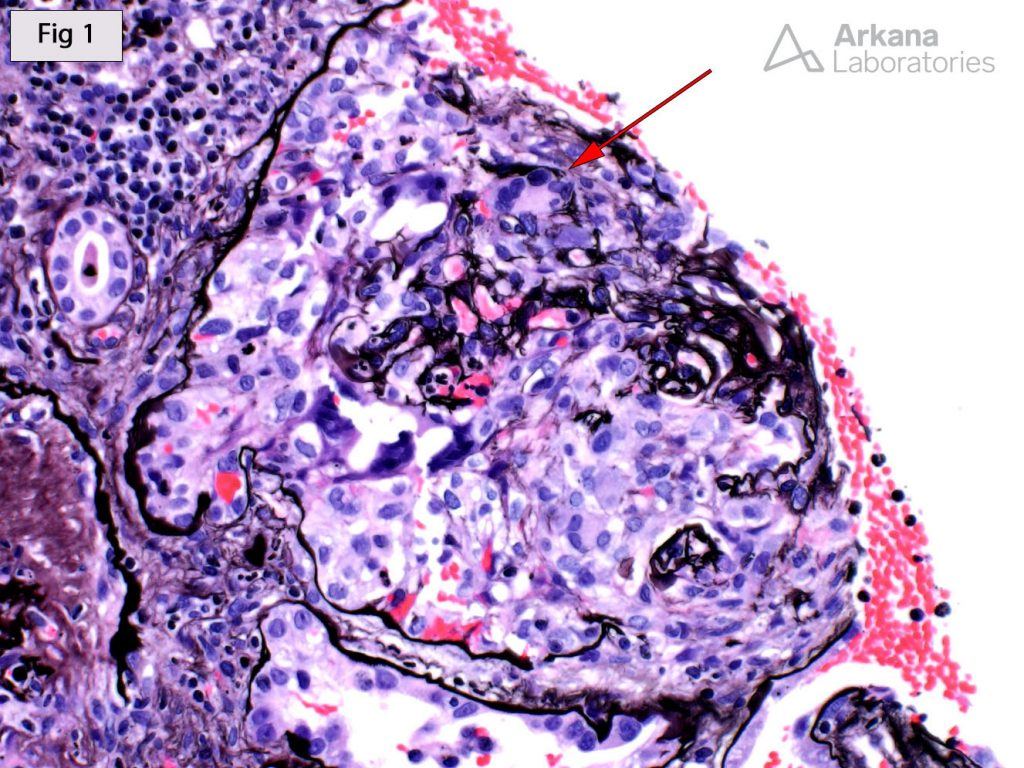 Anti GBM Disease | Teaching Points | Arkana Laboratories