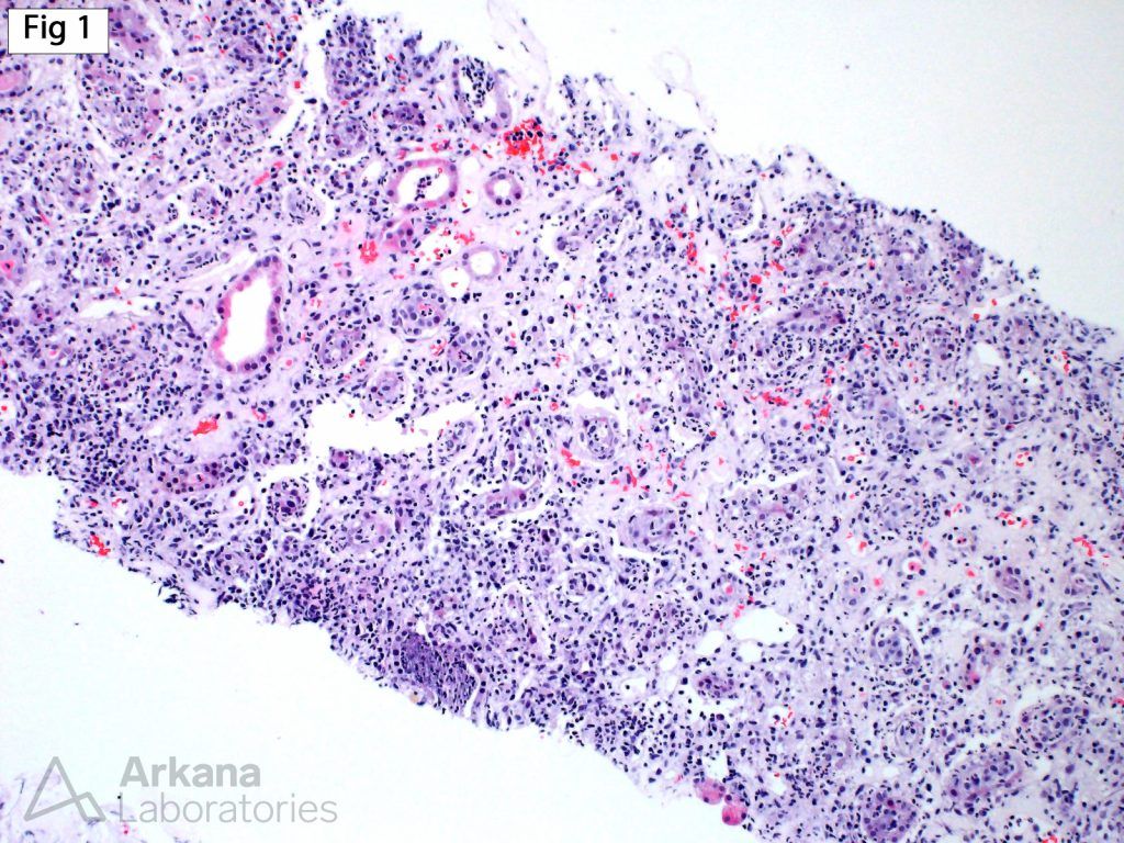 Acute Pyelonephritis | Teaching Points | Arkana Laboratories