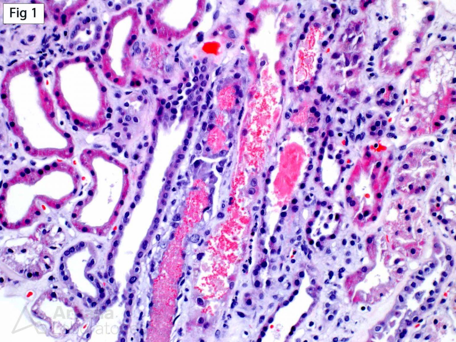 Intravascular Hemolysis | Teaching Points | Arkana Laboratories