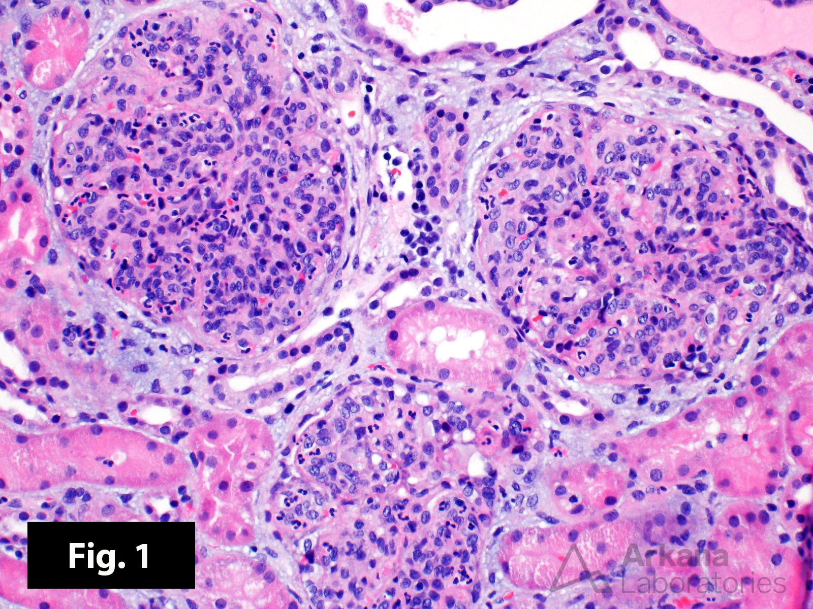 Acute Post Infectious Glomerulonephritis Teaching Points Arkana Labs