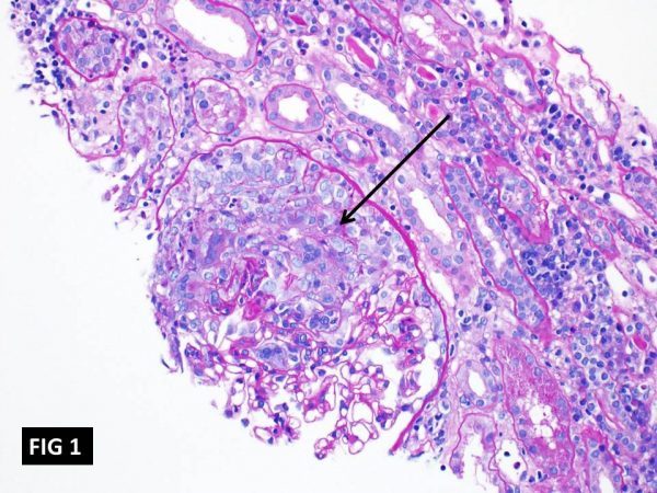 Anti-GBM (Anti-Glomerular Basement Membrane) | Teaching Points