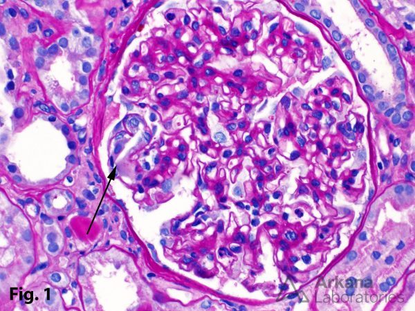 Cholesterol Microemboli | Teaching Points | Arkana Laboratories