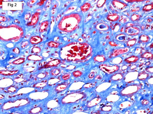 Acute Tubular Injury With Pigmented Casts | Teaching Points
