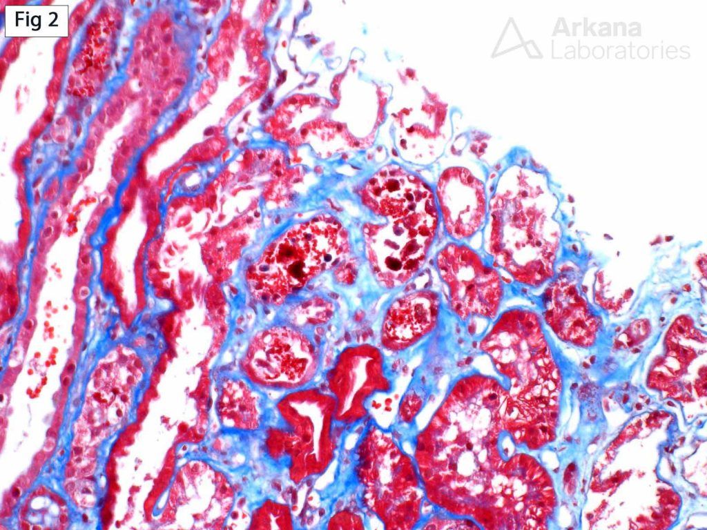 Intravascular Hemolysis | Teaching Points | Arkana Laboratories
