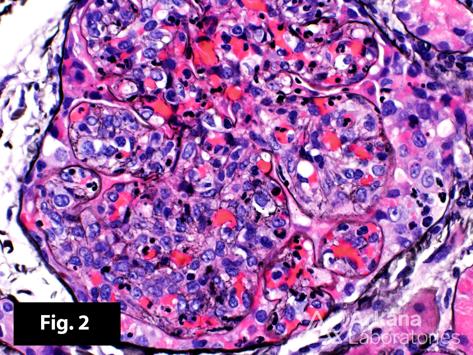 Acute Post Infectious Glomerulonephritis Teaching Points Arkana Labs