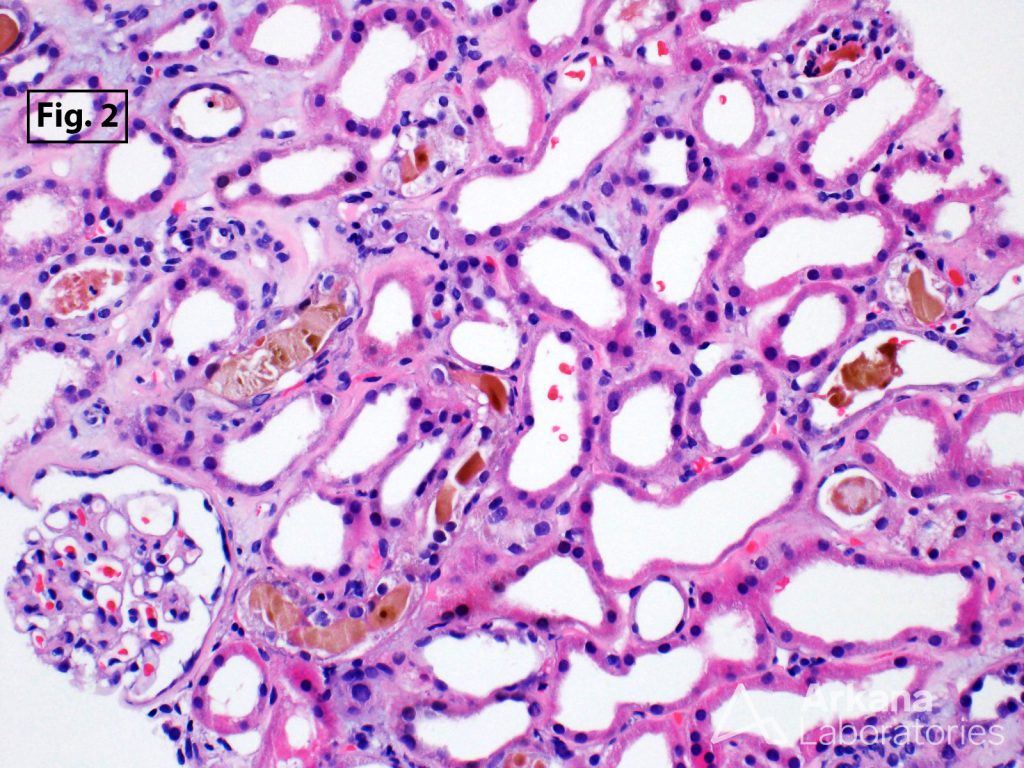 Bile Cast Nephropathy | Teaching Points | Arkana Laboratories