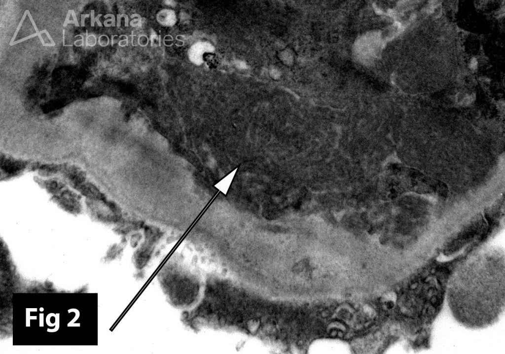 Cryoglobulinemic Deposits by EM | Teaching Points | Arkana Laboratories