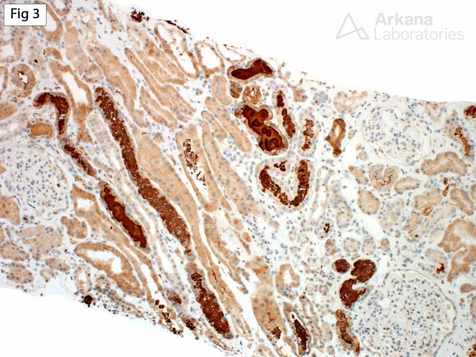 Intravascular Hemolysis | Teaching Points | Arkana Laboratories