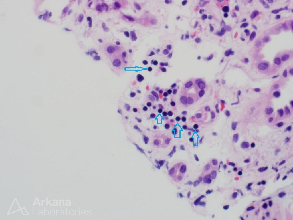 Nucleated Red Blood | Teaching Point | Arkana Laboratories