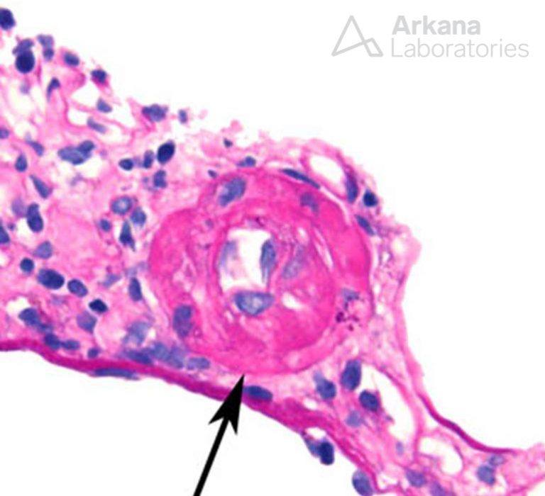 Calcineurin Inhibitor Toxicity | Pushing Glass | Arkana Laboratories