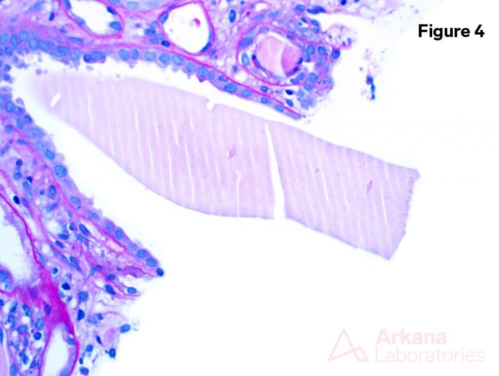 Kappa Light Chain Cast Nephropathy | Teaching Point | Arkana Labs