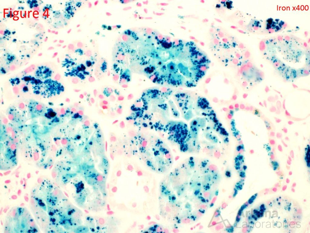 Hemosiderosis | Teaching Point | Arkana Laboratories