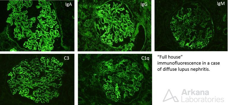 Lupus Nephritis | Art of Medicine | Arkana Laboratories