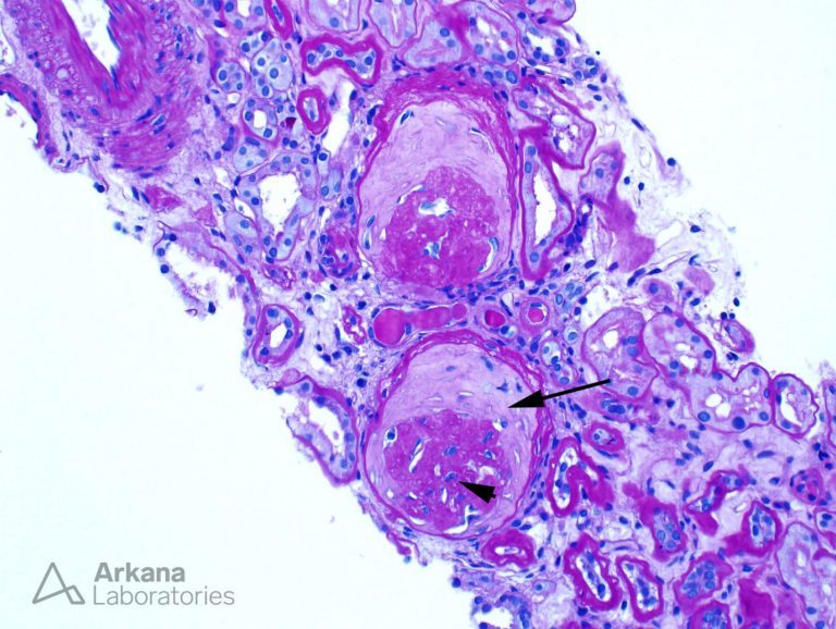Obsolescent Pattern in Glomerulosclerosis | Teaching Points