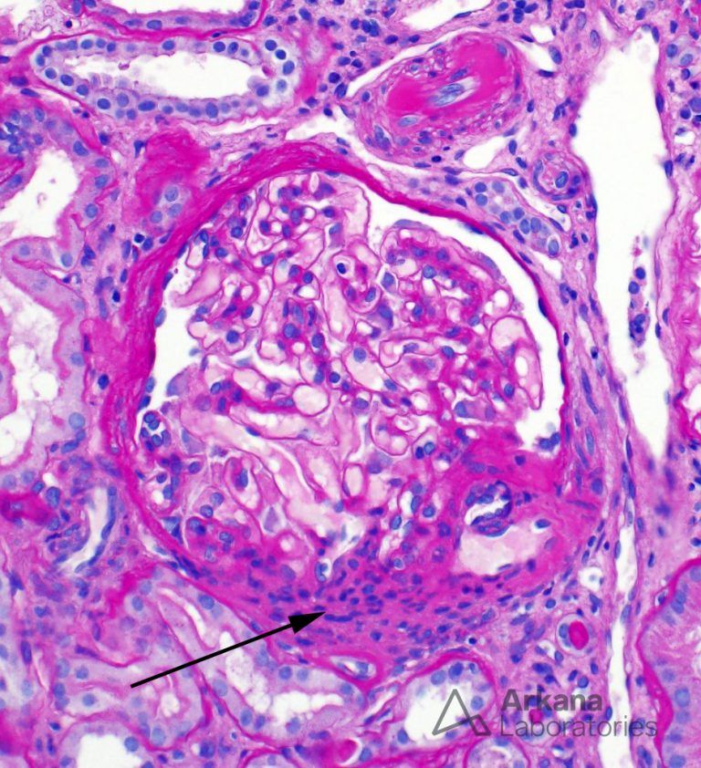 Juxtaglomerular Apparatus Hyperplasia | Teaching Points